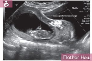 3 Months Pregnant – Symptoms, Belly & Ultrasound - MotherHow