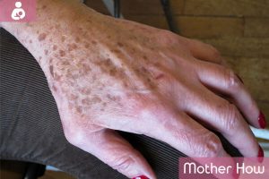 Baby Birthmarks: Types, Causes, Risks & Ways to Remove - MotherHow