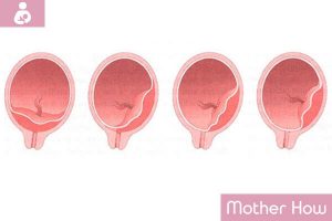 What is Placenta Previa? Types, Symptoms & Treatment - MotherHow